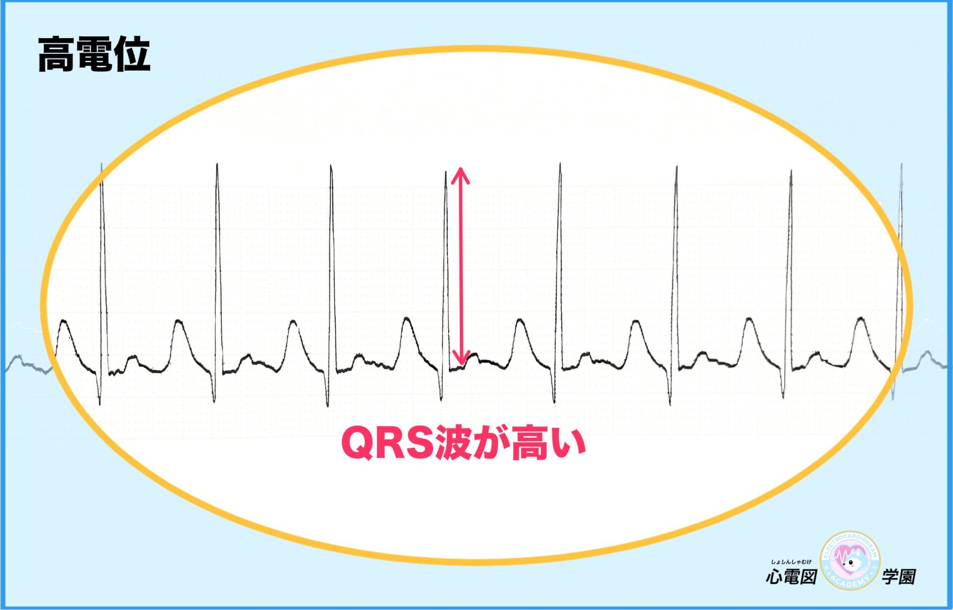 【初心者向け】これでなっとく！洞調律の見分け方〜まずは“基本”をおさえよう〜 - 心電図学園