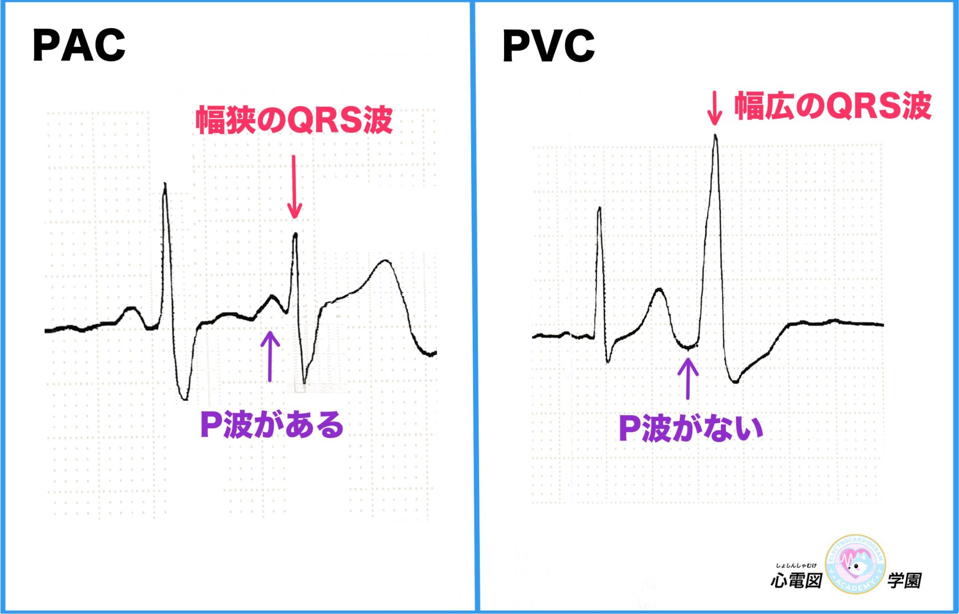 【初心者向け】これでなっとく！心室期外収縮（PVC）の見分け方 - 心電図学園