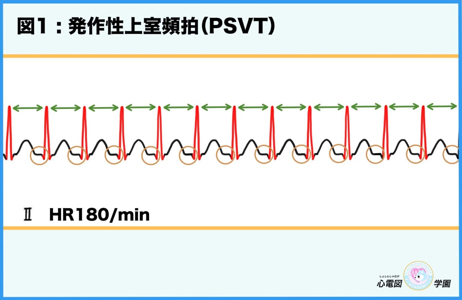 【初心者向け】これでなっとく！発作性上室性頻拍（PSVT）の見分け方 - 心電図学園